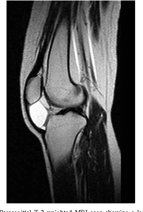 Ganglion Cyst Behind Knee
