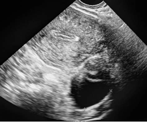 How Ultrasounds Detect Gallstones Tumors And Hidden Threats