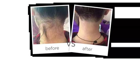 755nm808nm1064nm Diode Laser Hair Removal Device Adss Laser