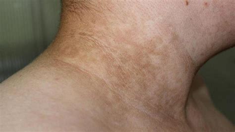Manchas En El Cuello