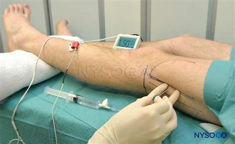 Popliteal Sciatic Nerve Block Landmarks And Nerve Stimulator Technique Nysora Nysora