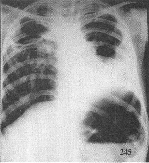图2—245 肺结核 胸部x线影像学图鉴