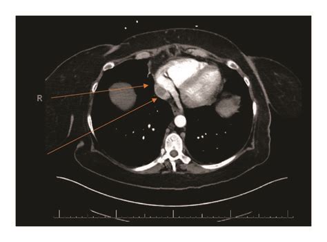 Extension Of Ivc Thrombus To The Right Atrium Download Scientific