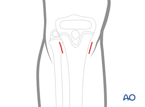 All Approaches To The Pediatric Distal Tibia And Fibula