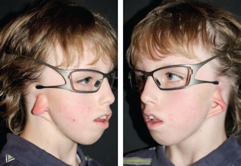 Chapter 5 Particular Cases Of Microtia Ento Key