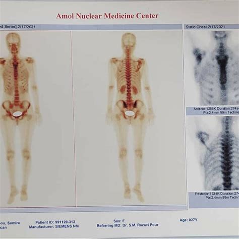 Whole Body Bone Scan Revealed Irregular Tracer Activity In The Lateral Download Scientific