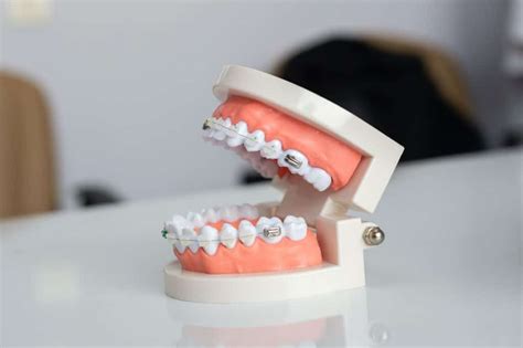 How Long Do Braces Take What To Expect When Getting Them