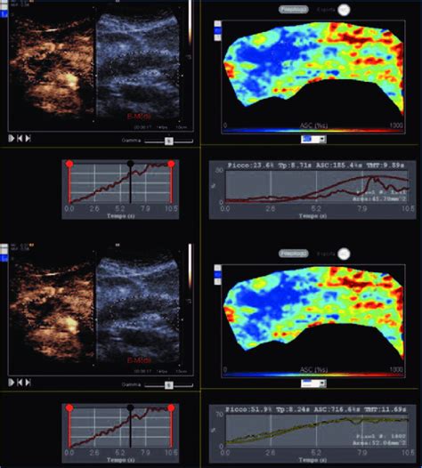 18 Pancreatic Adenocarcinoma Quantitative Perfusion Analysis At Ceus Download Scientific