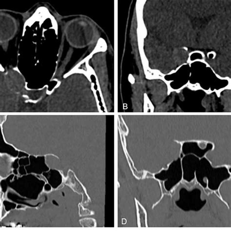Paranasal Sinus Ct Scans Multiplanar Reconstructions In Axial A Download Scientific Diagram
