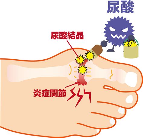 高尿酸血症とは リハビリ特化型デイサービスre Tac