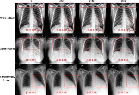 Visualizing Chest X Ray Dataset Biases Using Gans