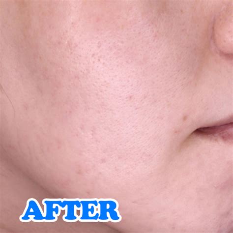 청소년 여드름 화장품 어떤거 사용하시나요 네이버 블로그