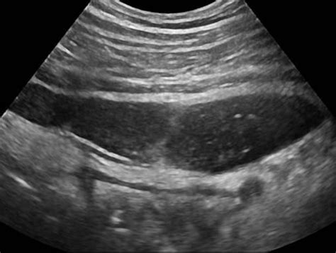 Abdomen And Retroperitoneum 1 5 Appendix Case 1 5 3 Complicated Appendicitis Ultrasound Cases