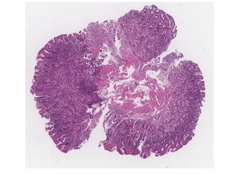 20 Metaplasia Histopathology Atlas