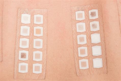 How To Do A Patch Test At Home According To A Malaysian Dermatologist Myeppo