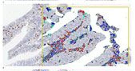 New Approaches In Quantitative Digital Pathology For Cancer Immunoscore