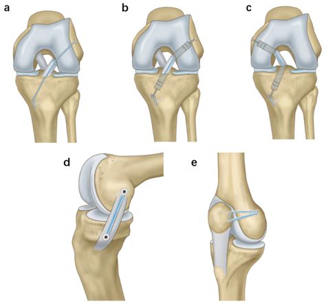 Surgical Model Of Internal Brace Technique In Knee Ligament Injuries Download Scientific