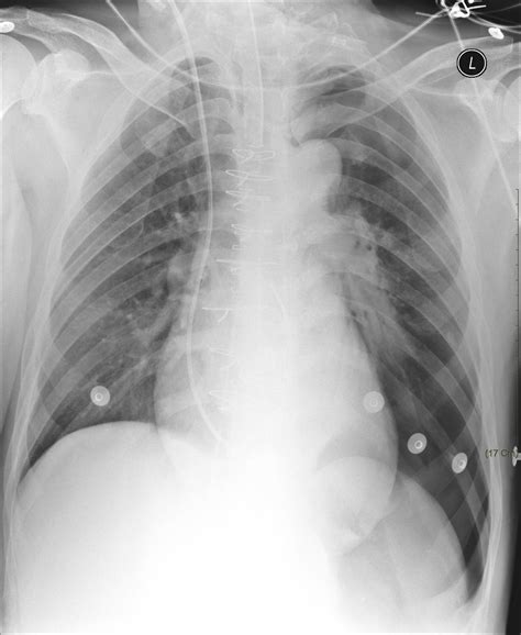 關於外科icu的一些事 Cxr Of Pneumothorax 2