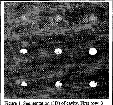 Figure 1 From Assessment Of 3d Myocardium Segmentation In Mri Using Endocardium Layer Expansion