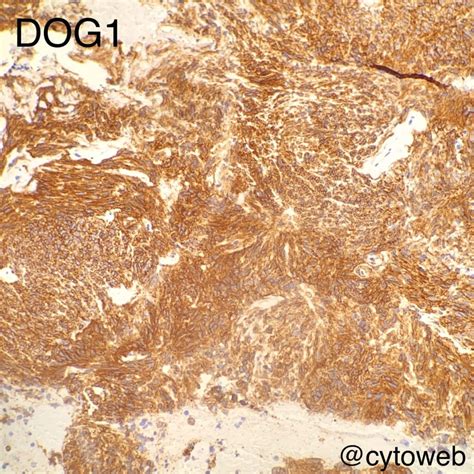 Mystery Cases Eus Fna 2 Nus Pathweb Nus Pathweb