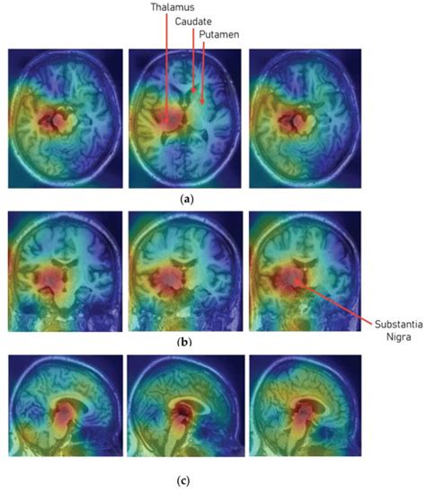 Detection Of Parkinsons Disease From 3t T1 Weighted Mri Scans Using 3d