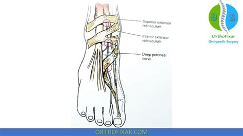 Tarsal Tunnel Release Procedure