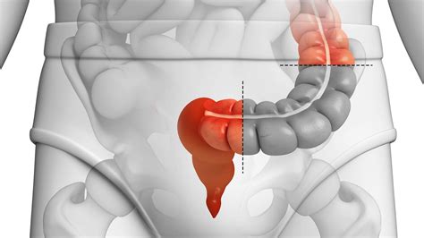 Elective Surgery For Diverticulitis Led To Qol Benefits Fewer Recurrences Medpage Today