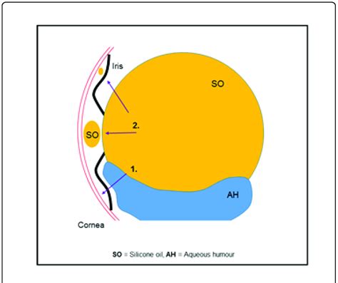 Pupil Block Glaucoma In A Silicone Oil Filled Aphakic Eye In The Download Scientific Diagram