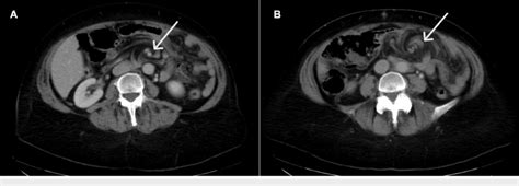 Ct Abdomen And Pelvis Axial The Mesenteric Swirl Sign Indicative Of Download Scientific