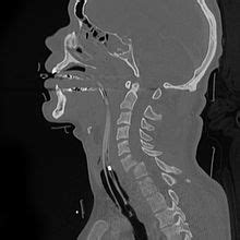 Cervical Fracture Wikipedia
