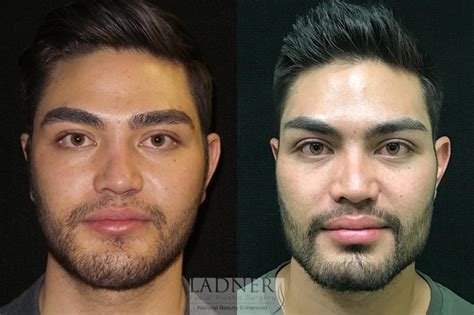 Plastic Surgery Before And After Chin