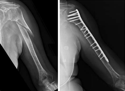 Humerus Fracture — Joseph J Schreiber Md
