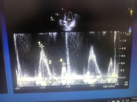 Echo Test 3 Diastolic And Systolic Function Flashcards Quizlet
