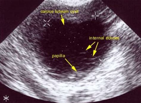 Luteal Phase Ultrasound