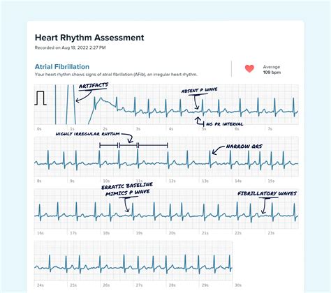 What P Waves Look Like On Your Watch Ecg Qaly