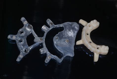 Full Arch Guided Restoration Using Stackable Guide Protocols