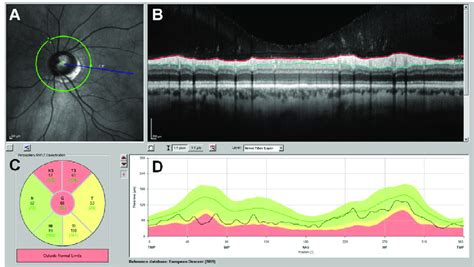5 Peripapillary Oct Scan Captured Using Spectralis Oct Heidelberg Download Scientific Diagram
