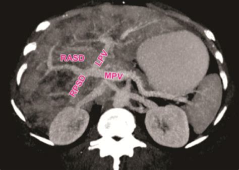 Showing Type Ii Or Trifurcation Of Portal Veins Into Right Anterior Download Scientific
