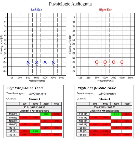 Assr Results For Case 2 Profound Bilateral Sensorineural Hearing Loss Download Scientific