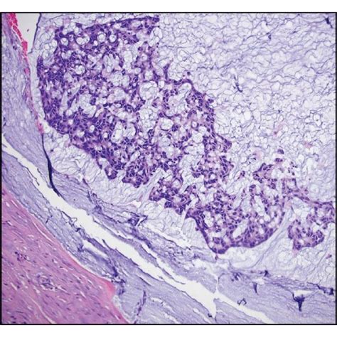 Histologic Subtypes Of Ipmn Based On Histomorphology Of The Epithelia