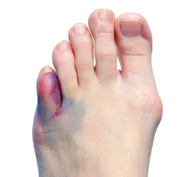 Broken Toe Not Healing What To Do New Health Advisor