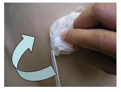 Peritoneal Dialysis Catheter Exit Site Care At Wade Arnold Blog