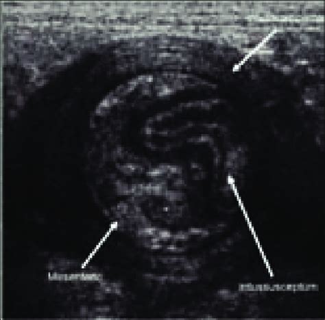 Intussusception Gives A Pathognomonic Appearance Of Multiple Rings