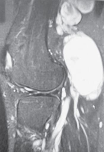 Neurofibroma Neupsy Key