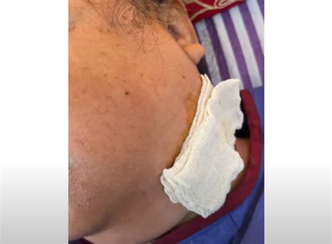 Submasseteric Space Infection Archives New Pimple Popping Videos