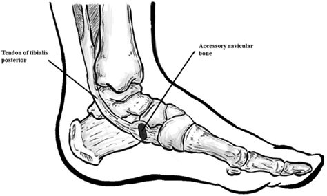 Os Naviculare Wikism Sports Medicine Wiki