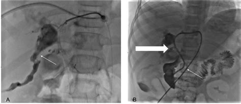 Percutaneous Transhepatic Biliary Drainage Ptbd And Embolization Of