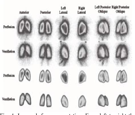 Automatic Detection Of Pulmonary Embolism Using Computational Intelligence