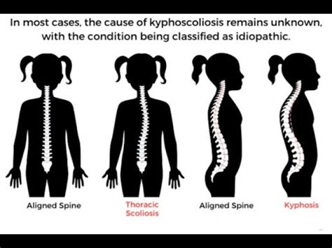 Kyphoscoliosis Abnormal Curvature Of Spine Definition Causes