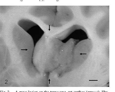 Figure 1 From Histiocytic Sarcoma In The Brain Of A Cat Semantic Scholar